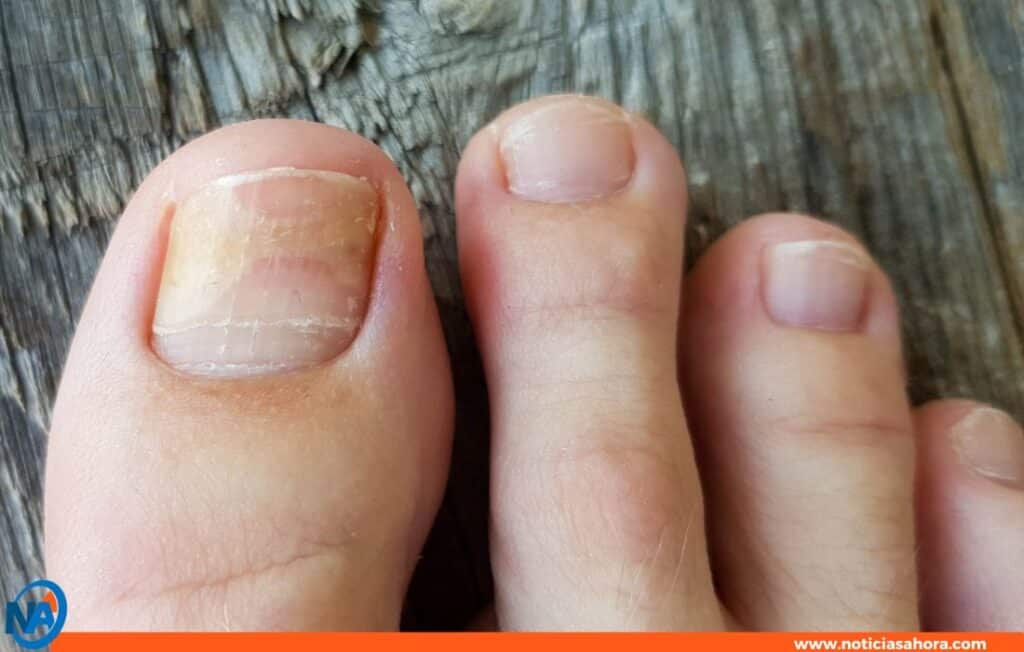 ¿Qué es la onicomicosis en uñas de los pies?